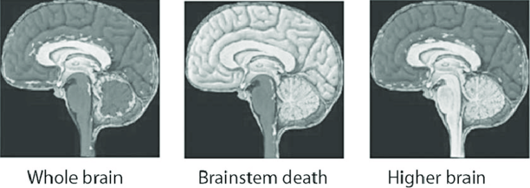 Brain Stem Death - The Study IAS