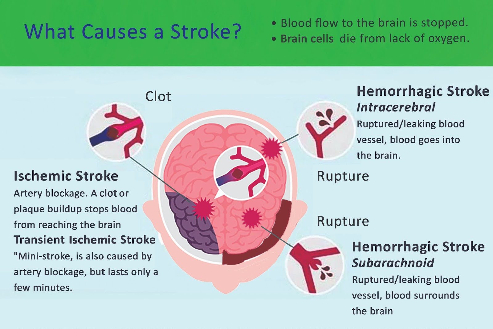 Surge In Global Stroke Rates - The Study IAS
